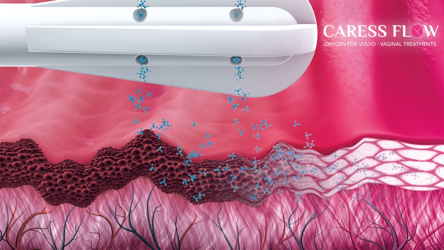 Caress Flow - innowacyjna metoda leczenia, poprawiająca jakość życia kobiet